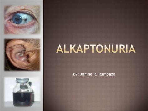 Alkaptonuria Pptx