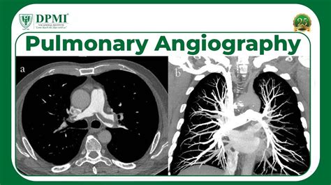 Pulmonary Angiography Indications Techniques And Results What Is