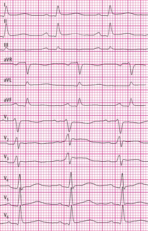 Figure 031 2424 Echocardiography Of A Patient With Acute Pericarditis Pr Segment Depressions