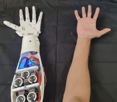 Designing A 3d Printed Emg Bionic Hand As A Low Cost Alternative To