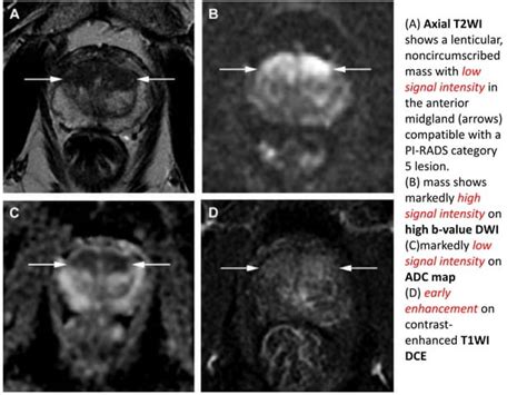 Mp Mri Prostatepptx