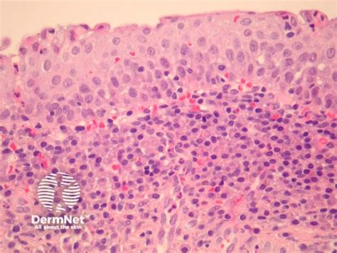 Zoons Plasma Cell Balanitis
