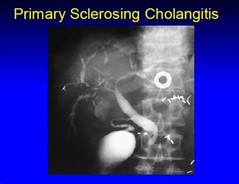 Primary Sclerosing Cholangitis Flashcards Quizlet
