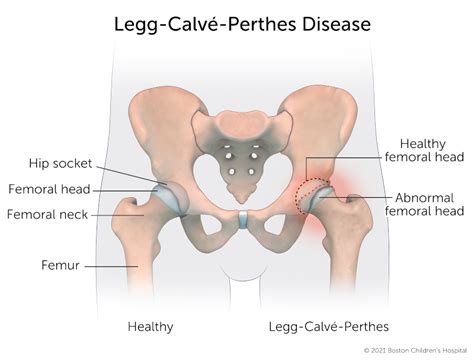 Getting Closer To The Cause Of Legg Calve Perthes Disease Wdgsg