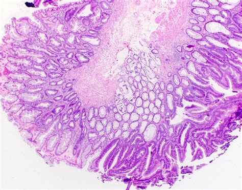 Hyperplastic Polyp Pathology Outlines