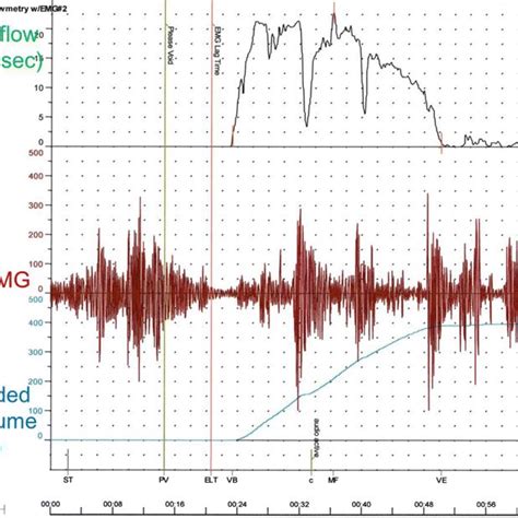 Normal Bell Shaped Flow Pattern Note That The Uroflow Curve Has A