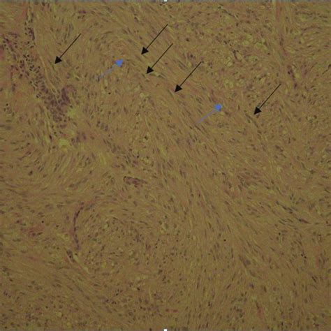 Gastrointestinal Stromal Tumor Low Grade Spindle Cell Type With Download Scientific Diagram