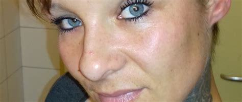 Durch Zahlreiche Große Narben Körperlich Entstellt Spenden Sammeln