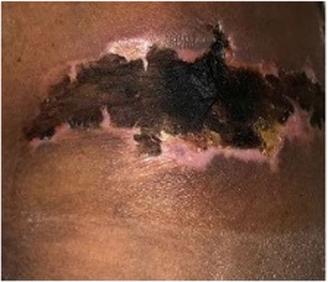 Retiform Purpura Journal Of The American Academy Of Dermatology