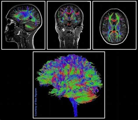 Simultaneous Multi Slice Sms Speeds Up Imaging Medizzy
