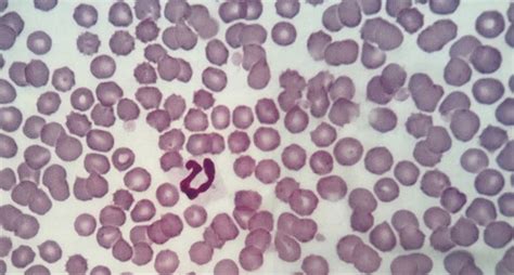 Unit 2 Clin Path Flashcards Quizlet