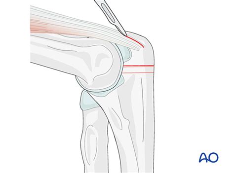 Plate Fixation Of Olecranon Osteotomy