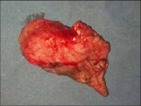 Picture Showing Excised Tumor Mass And Draining Lymph Node Fig 1 Download Scientific Diagram