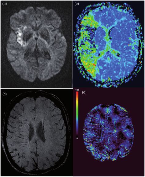 Diffusion Weighted Imaging Dwi Mean Transit Time Mtt