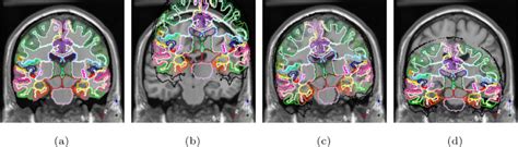 Torchio A Python Library For Efficient Loading Preprocessing Augmentation And Patch Based