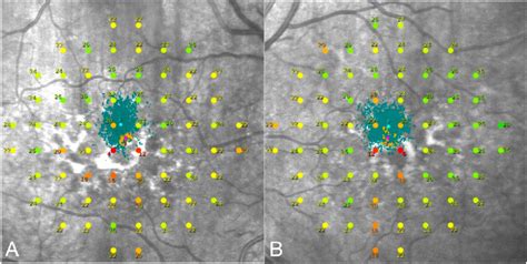 Microperimetry Sensitivity Map Showing Reduced Sensitivity In The Right