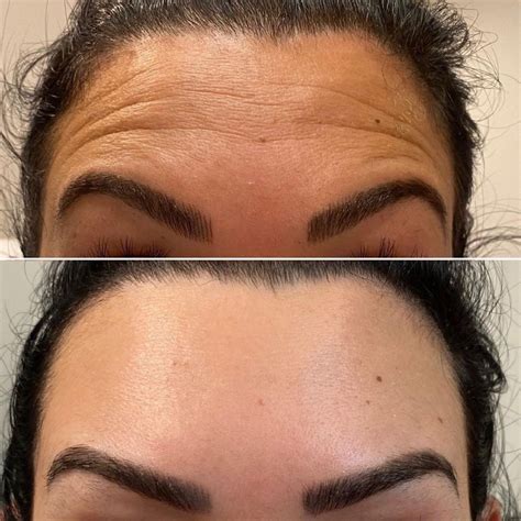 Neurotoxins Injections Before And After Gallery Essentially Bare Laser