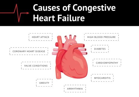 Does Congestive Heart Failure Cause Wheezing Dbku