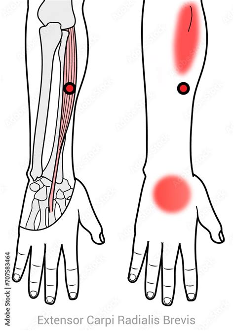 Extensor Carpi Radialis Brevis Myofascial Trigger Points And Associated Pain Locations Stock