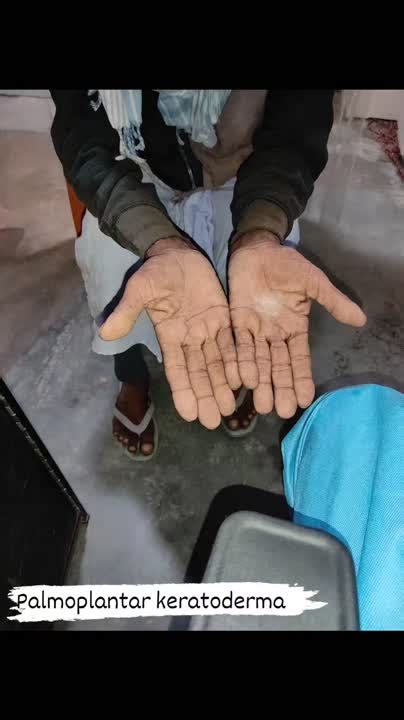 Dr Mazhar Imam Sajid On Linkedin Ppk Palmoplantarkeratoderma Thickskin Hyperkeratosis