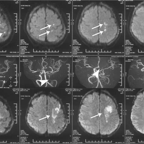 A Initially Axial Dwi Of Brain Showed Acute Infarction In Left Download Scientific Diagram