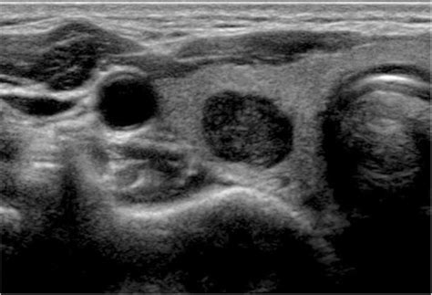 Clinical And Ultrasonographic Features Of Medullary Thyroid