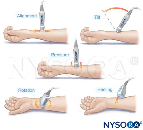 Optimizing An Ultrasound Image Nysora
