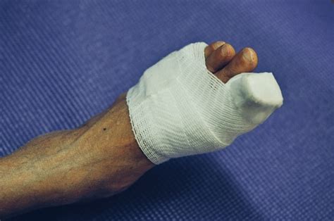 병원에서 클로즈업의 A 정형 외과 고정 석고에 부상 여자의 발 부 목 치료를 위한 부상 발 건강 및 의료 치료 개념 가까운에 대한 스톡 사진 및 기타 이미지 Istock