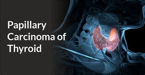 Papillary Carcinoma Of Thyroid