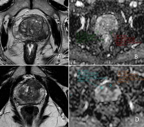A B Adc Ratio Calculation In A Suspected Pz Lesion In A 71 Years Old
