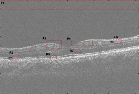 Figure 3 From Comparison Of Pde Based Nonlinear Diffusion Approaches For Image Enhancement And