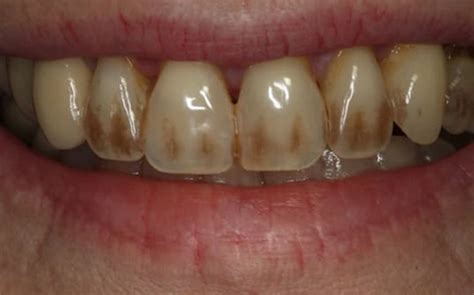 Chromogens On And In Teeth Definitions And Origins How Whitening