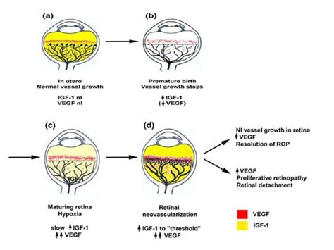 Retinopathy Of Prematurity Rop Medchrome