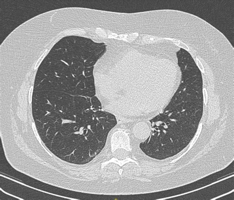 Marked Deterioration In Rheumatoid Arthritis Associated Bronchiectasis Following Treatment With