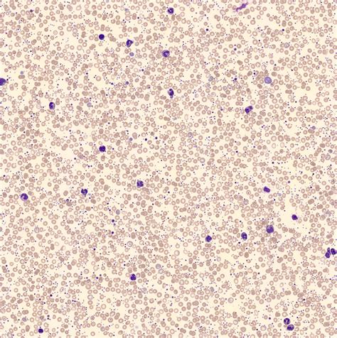 Do You Think This Patient Has A Bleeding Tendency R Hematology