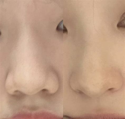 오른쪽 코처럼되려면 뭐해야해ㅠㅠ 40 인스티즈 Instiz 일상 카테고리