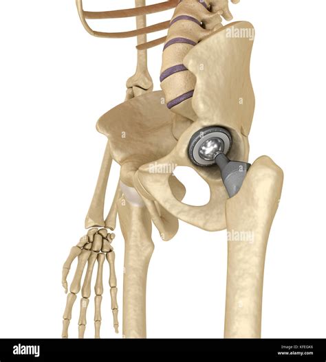Hip Replacement Implant Installed In The Pelvis Bone Medically