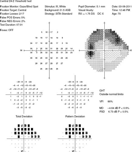 Glaucoma Field Defects