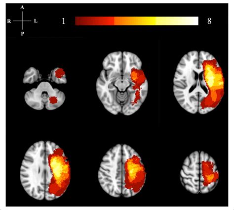 Lesion Location Map This Image Illustrates The Lesion Distribution