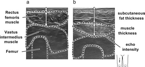 Representative Ultrasound Images Of The Rectus Femoris Muscle In A Download Scientific Diagram