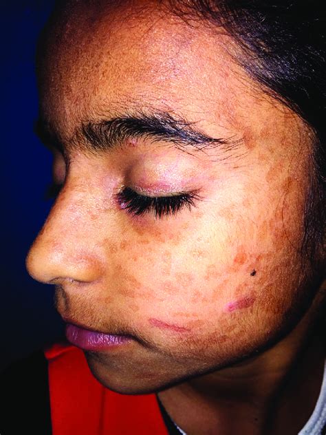 Multiple Round To Linear Atrophic Scars And Few Erythematous Papules