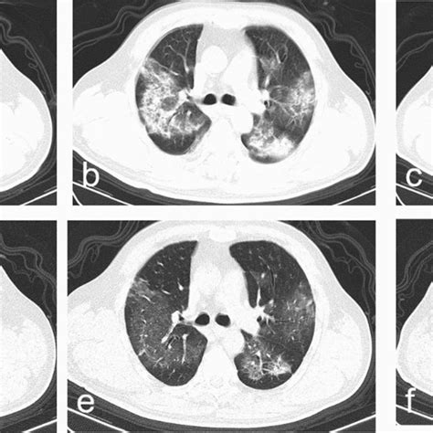 Thin Section Ct Scans In A Man Infected With Sars Cov 2 Scan Obtained Download Scientific