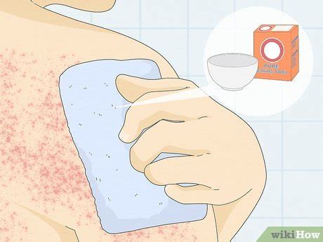 How To Treat Heat Rash 14 Steps With Pictures WikiHow Health