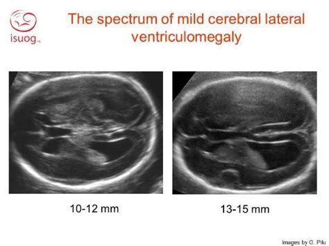 Lateral Ventricle Ultrasound