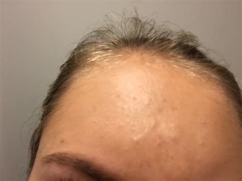 Strange Skin Texture On Epiduo Side Effect Picture Prescription