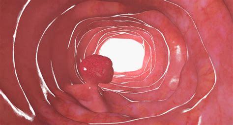 Polyp Digestive D Model