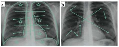 What Is Lung Nodular Density At Nadia Arsenault Blog