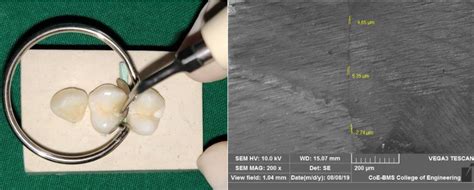 Figure Ii From Effect Of Composite Resin Preheating And Ultrasonic
