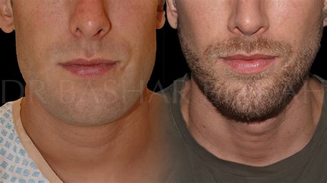 Did Disha Patani Undergo Cosmetic Surgery Rumours Sparked By Viral Video Bizrahmed