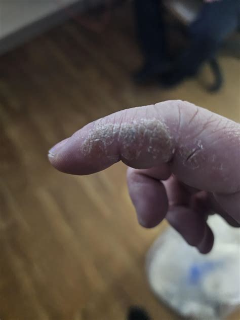Weird Wart Like Growth On My Finger Rdermatologyquestions